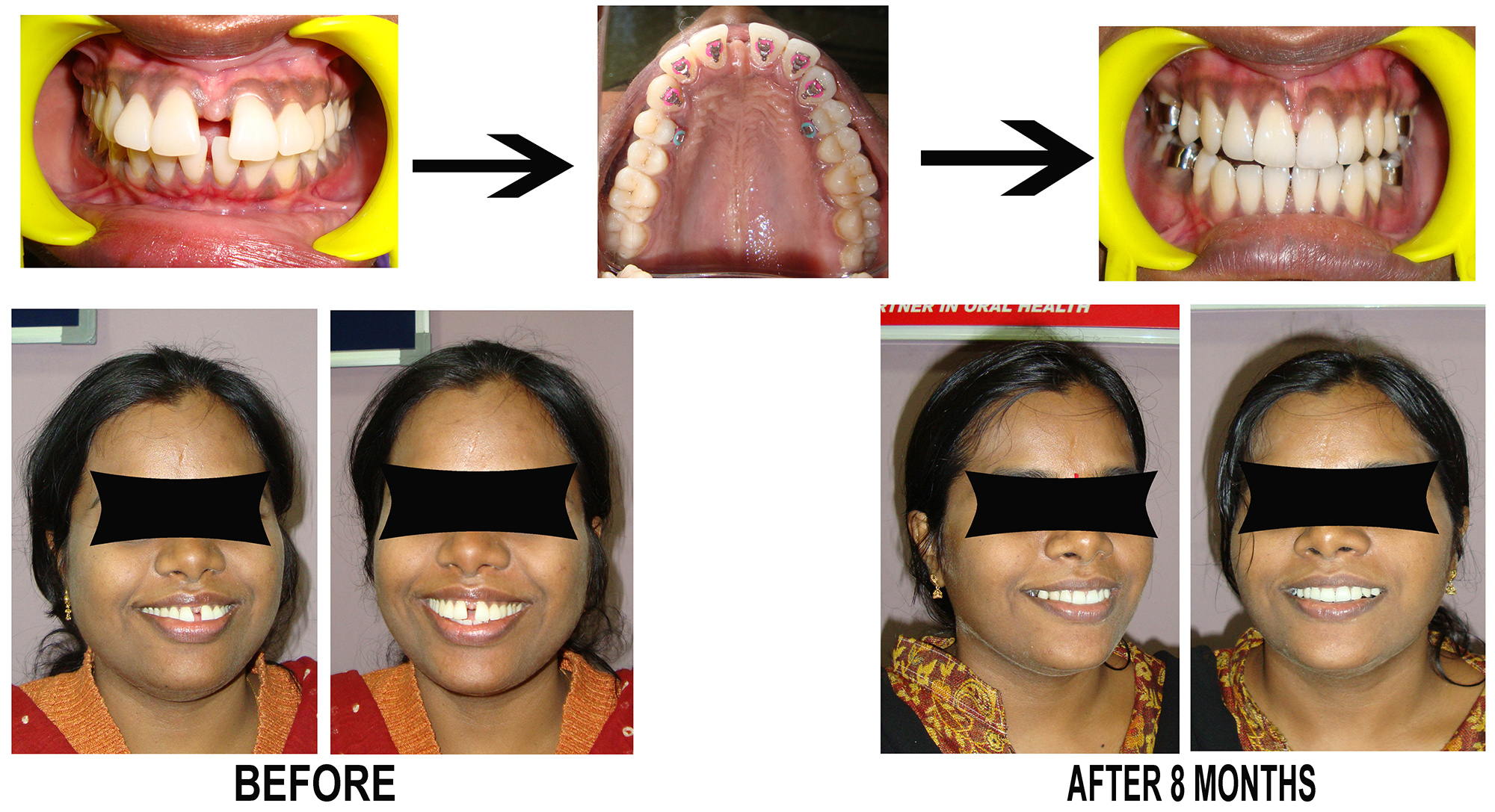 Invisible Braces – Maximus